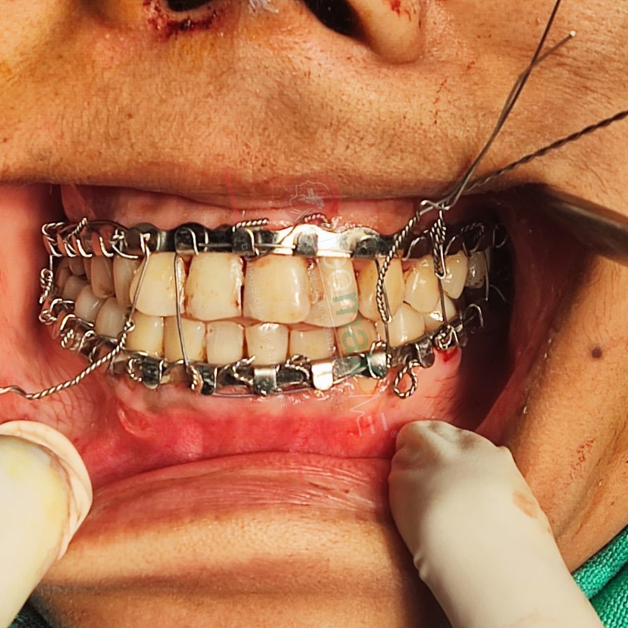 First Alloplastic Jaw Transplant Done In North East – KRC TIMES